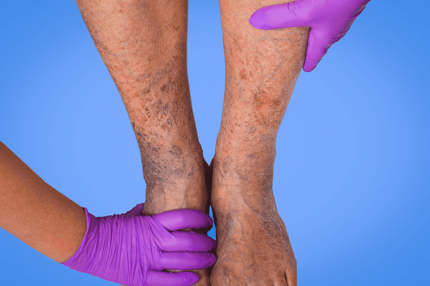 Understanding the Stages of Venous Leg Ulcers | Advanced Vein and Laser ...